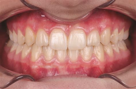 Brava A Novel Orthodontic System Resolves A Functional Shift