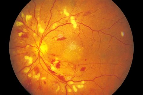 Hypertensive Retinopathy Oasiseye Specialists