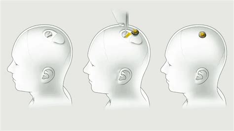 Here Is Why The Medical Community Is Opposing Elon Musk S Neuralink