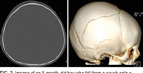 Figure From Pediatric Skull Fracture Diagnosis Should D CT Reconstructions Be Added As