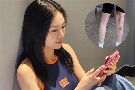 Ninh Dương Lan Ngọc để Lộ Vết Bầm Lớn Trên Cơ Thể Khiến Fan Lo Lắng