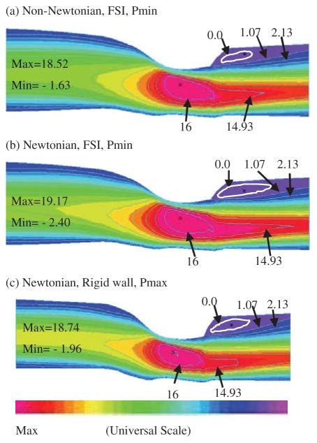 In Vivo Ex Vivo MRI Based D Non Newtonian FSI Models For Human Atherosclerotic Plaques Compared
