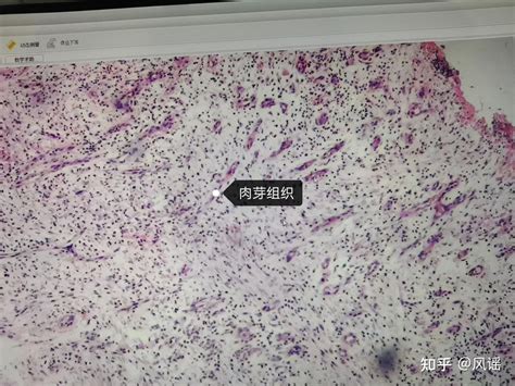 病理学实验切片和病变特点（期末总结） 知乎