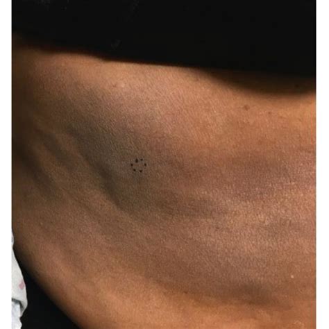 A Large Slightly Scaling Hyperpigmented Patch On The Right Abdomen