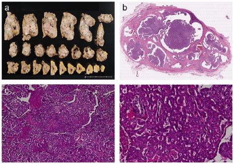 Macroscopic And Microscopic Findings Of The Resected Tissue Specimen