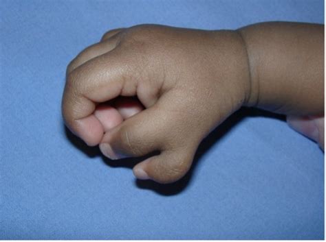 Anomalies Du Pouce Duplicationhypoplasiepouce Triphalangique Pouce