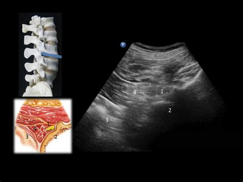 Paramedian Oblique Transverse Scan Of Lumbar Paravertebral Region