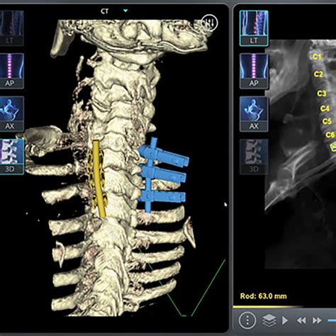 Preoperative Software Showing The Surgical Robotic Plan With A