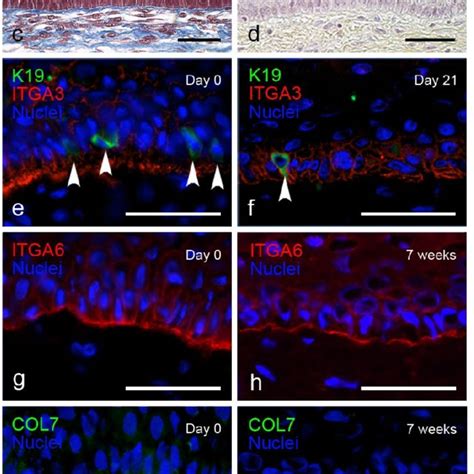 Right Axilla Of A Patient Showing Hyperpigmentation And Papillomatosis