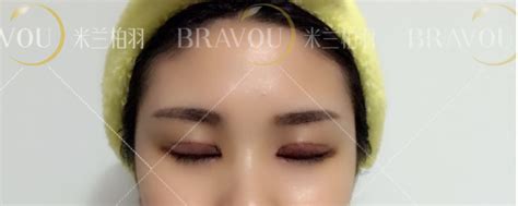 双眼皮手术后又疤痕增生怎么办 知乎