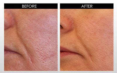 Ipsa Treatment Of The Week Micro Skin Needling With Dermapen Ipsa
