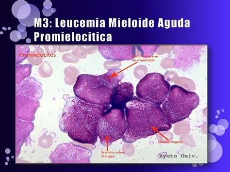 Leucemia Mieloide Aguda
