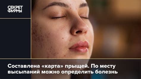 Прыщи на лице как от них избавиться Новости — Секрет фирмы