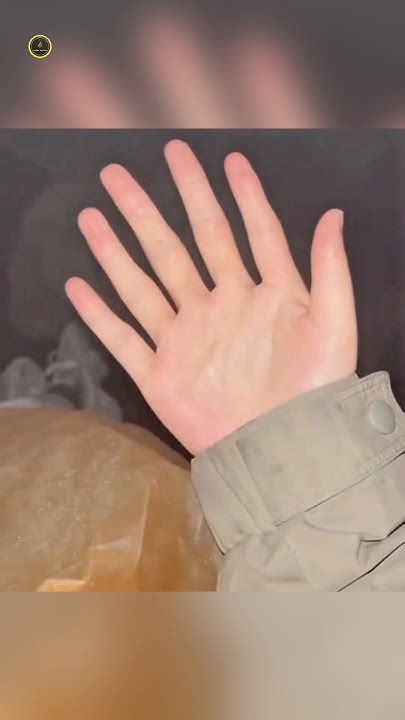 Polydactyly And Syndactyly Youtube