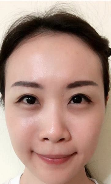 Botulinum Toxin A Injection Botox Dysport Xeoul Clinic