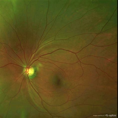 Ways To Help Glaucoma Patients Stay On Track