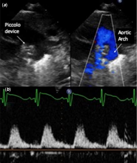 Aortic Migration Of Amplatzer Piccolo™ Ductal Occluder Cardiology In