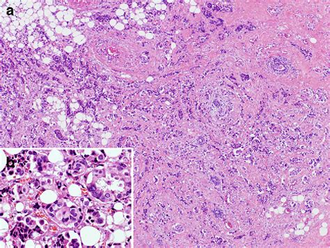 A Case Report Of Pigmented Mammary Pagets Disease Mimicking Nevus Of