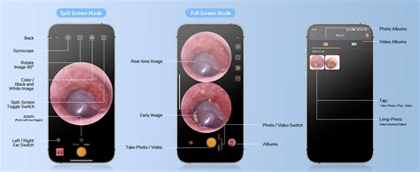 Amazon Anykit Digital Otoscope With Gyroscope HD Ultra Clear View