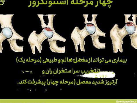 عکس سیاه شدن استخوان پا