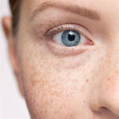 Freckles Explained How To Check Your Spots For Cancer Or 50 Off