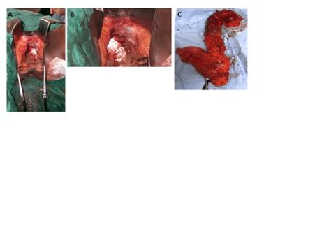 Intraoperative Images A Patient Completed Perineal Dissection Download Scientific Diagram