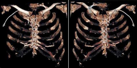 The Retrosternal Space Of Both Parts Of The Sternum Was Separated From