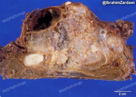 Chondrosarcoma