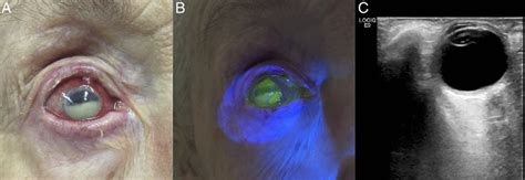 Keratitis Causes Symptoms Diagnosis Prevention Treatment