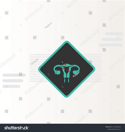 Uterine Fibroid Embolization Procedure Shrink Noncancerous Stock Vector