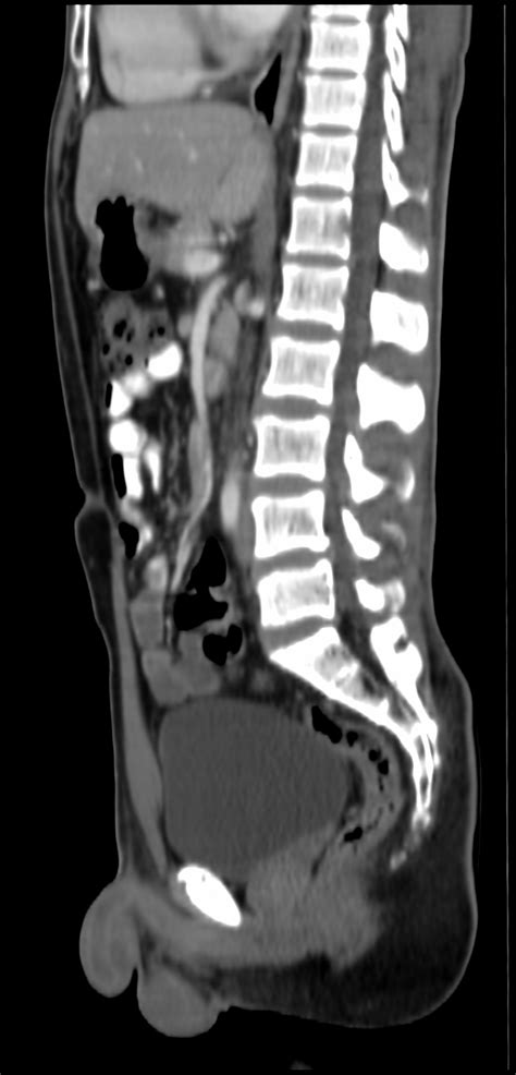 Left Paraduodenal Hernia Image
