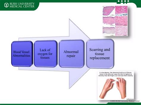 Updating Our Understanding And Management Of The Gut In Scleroderma Pptx