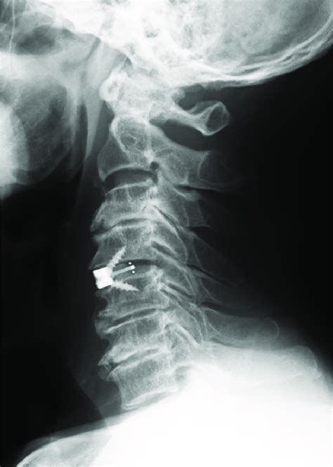 Postoperative Lateral Cervical Image Showing Acdf At C4 5 Download