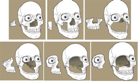 Classification Of Maxillectomy Defects 7a Type I Limited Maxillary