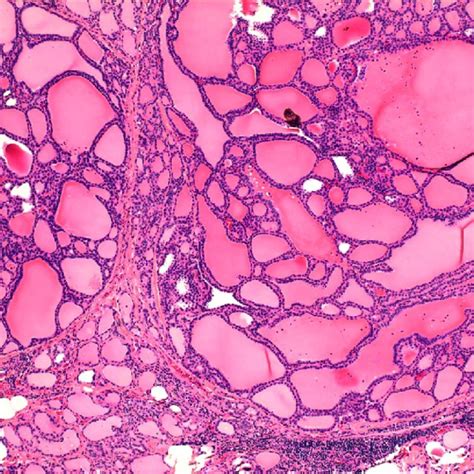 Thyroid Tissue With Hyperplastic Adenomatoid Nodules Hande X100 Download Scientific Diagram