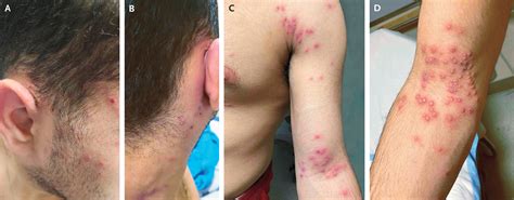 Case 16 2024 A 20 Year Old Man With A Pustular Rash New England Journal Of Medicine