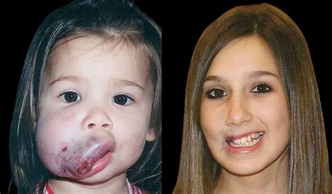 Venous Malformations Lip 2 Vascular Birthmark Institute
