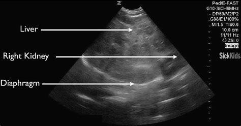 The Standard View Of The Right Upper Quadrant Of The Pocus E Fast