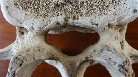 Radiologia Rmc Koda Canal Medular