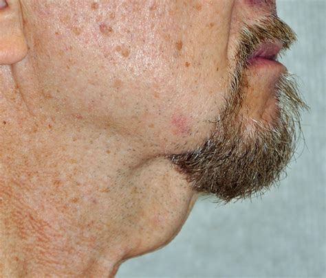 The Direct Necklift With A Wavy Scar Pattern Explore Plastic Surgery