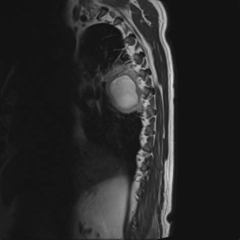 Radiopaedia Case Thoracic Paravertebral Abscess And Osteomyelitis Id