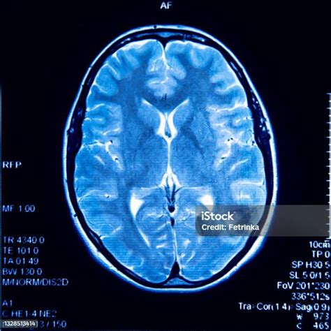 뇌의 Mri 이미지 Mri 스캐너에 대한 스톡 사진 및 기타 이미지 Mri 스캐너 동맥 조영도 0명 Istock