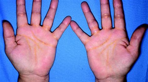 High Cholesterol Hypercholesterolemia Symptoms And Signs You Should