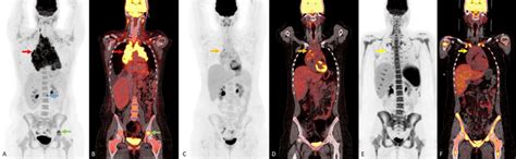 Fdg 18 Petct Mip Image A And Coronal Fdg Petct Fusion Images B