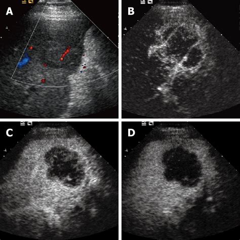 Cholangiocarcinoma Ultrasound