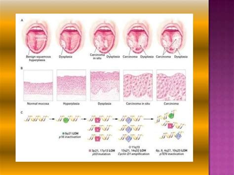 Oral Squamous Cell Carcinoma