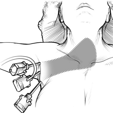 Dissection Area Using Transaxillary Approach Download Scientific Diagram
