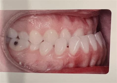Class Iii Underbite R Jawsurgery
