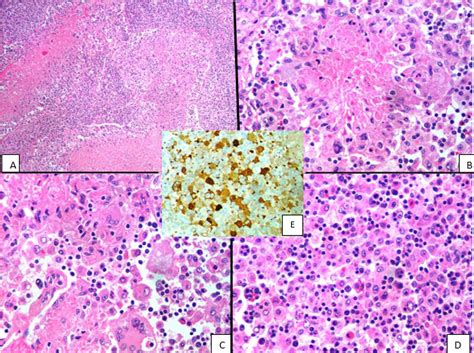 A X100 Magnification Of Hematoxylin And Eosin Stained Image Of Lymph