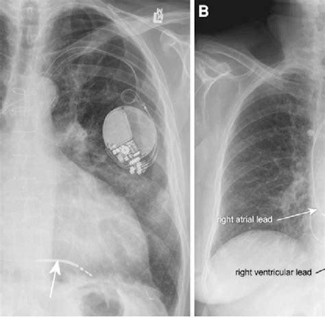 Placement Of Transcutaneous Pads To Facilitate Intraoperative External Download Scientific